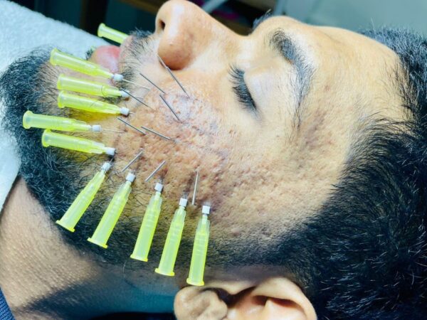 Collagen Threads – My Cosmetic Clinic